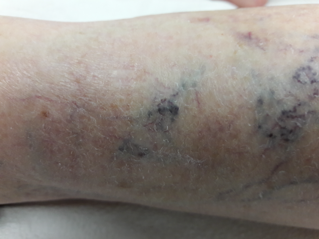The Complete Guide to Chinese Medicine Bloodletting — by Dean Mouscher